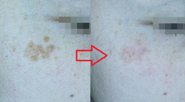 리뉴미피부과 화곡점 인라이튼 피코 토닝 루비 토닝 포토나 토닝 양측성 후천성 오타양 모반 오타 반점 눈밑 기미