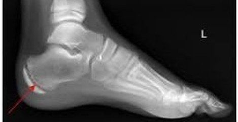 중학생인데 발뒤꿈치가 아파요. 종골골단염(calcaneal apophysitis), 세버병(Sever's disease ...