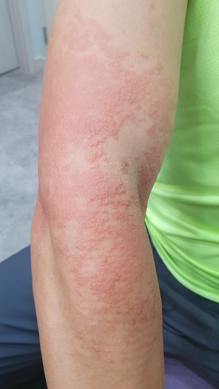 운동 코치에서 토시를 입은 팔에 발생한 땀띠, heat rash, miliaria rubra.. "여름마다 그렇더라 ...