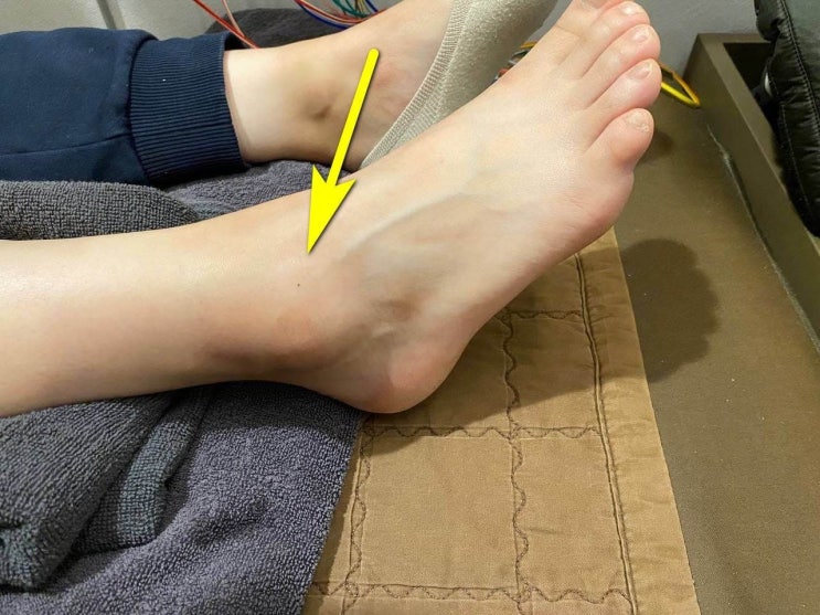 발목인대 늘어났을때 얼마나 치료해야하나요 전거비인대 종비인대 발목염좌 한의원 네이버 블로그