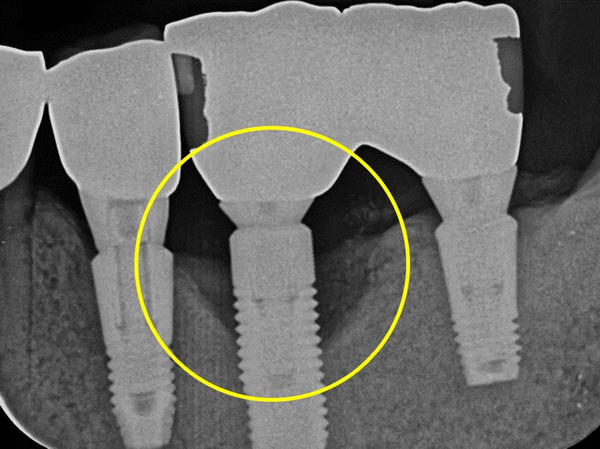 골이식이 필요없는 아스트라(Astra)의 프로파일 임플란트(Profile implant) : 네이버 블로그