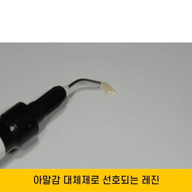 "아말감 치료 괜찮나요?" : 네이버 블로그