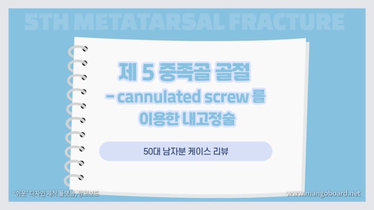 발등을 접질린 후 심하게 붓고 아파요. - 제 5 중족골 골절 - Jones Fracture - cannulated screw ...