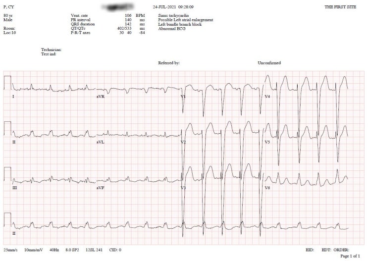 LBBB with elevated cardiac markers (ft. Sgarbossa criteria) : 네이버 블로그