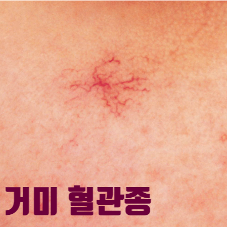 거미혈관종Spider angioma : 네이버 블로그