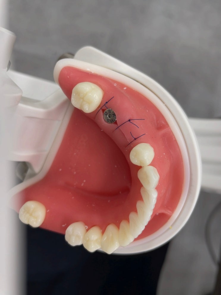 오스템 Positioning Guide KIT(Parallel Guide KIT) & Smart Guide KIT & CAS ...