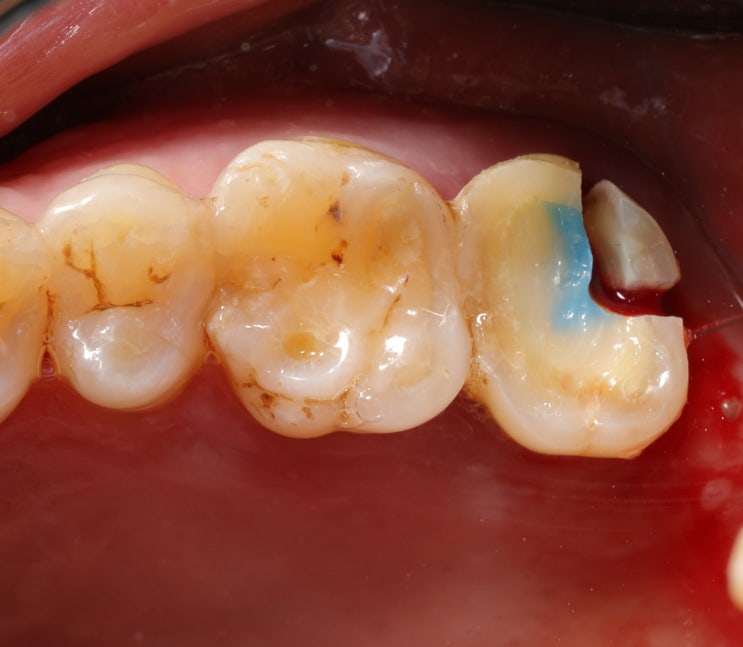 자연치아 살려쓰는 치근 절제술(Root resection, root amputation) : 네이버 블로그