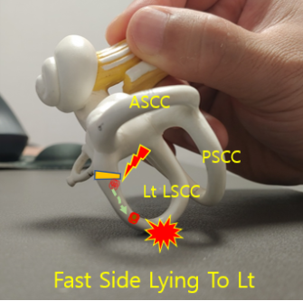 [BPPV][Topic] Gufoni(Appiani) Maneuver의 합리적인 실시 방법에 대한 고민 1. 이론 편 : 네이버 블로그