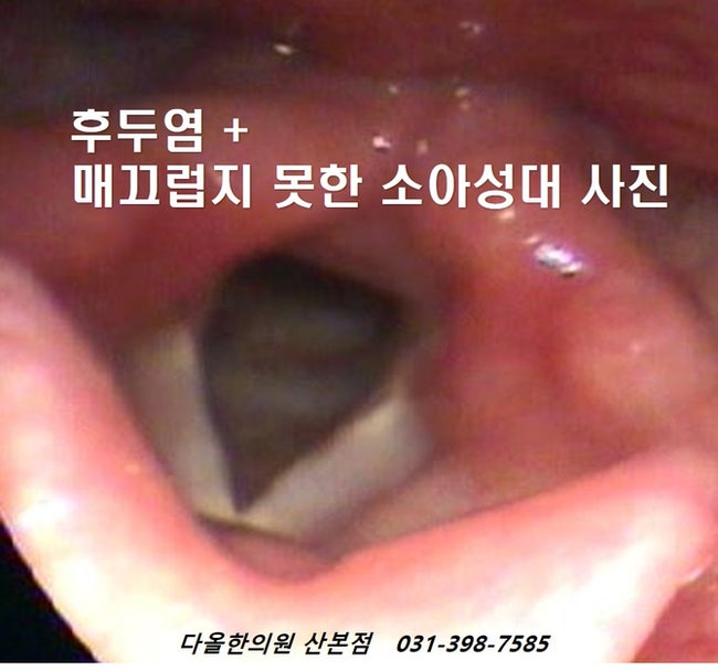 쉰목소리 검사 쉰목소리가 계속되는 우리아이 변성기 성대결절 다올한의원산본점 네이버 블로그
