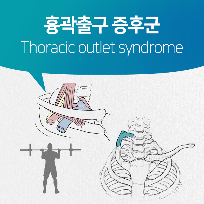 원인 모를 팔 저림 흉곽출구증후군일까 네이버 블로그