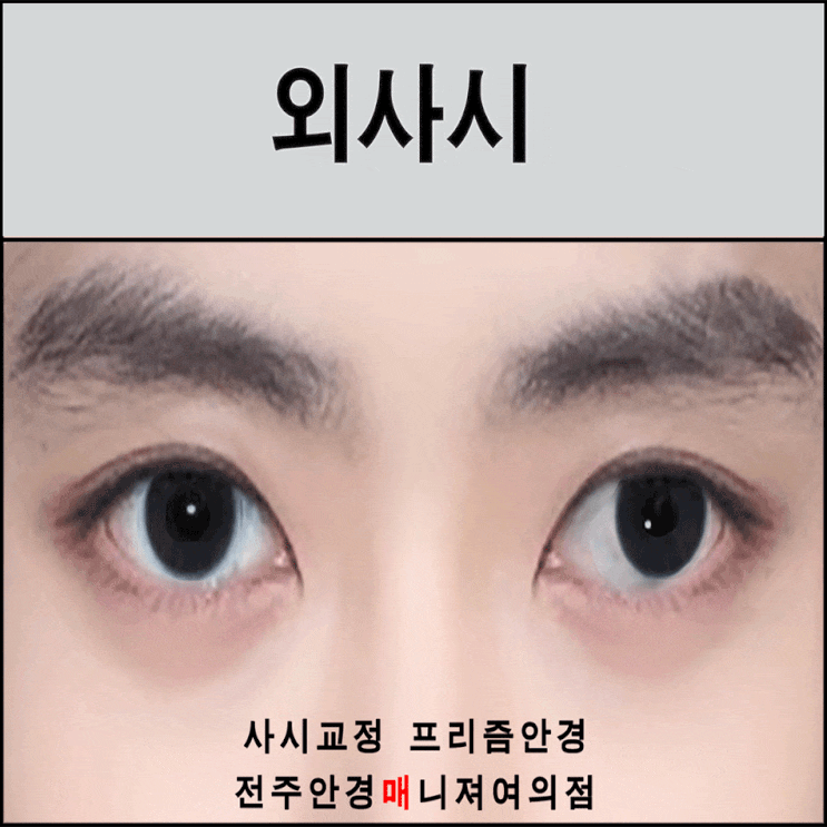 전주 프리즘 안경】 심한 외사시로 물체가 둘로 보이는 복시와 눈 돌아감 교정 프리즘 안경 네이버 블로그