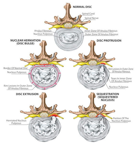 요추 HNP (disc herniation, lumbosacral radiculopathy) 양상 : 네이버 블로그