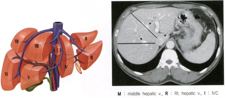 liver segments & liver resection : 네이버 블로그