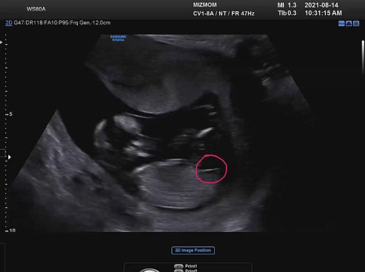 재미로 보는 태아성별 확인방법초음파 각도법 반지점 바늘점 베이킹소다 중국황실달력태몽 네이버 블로그