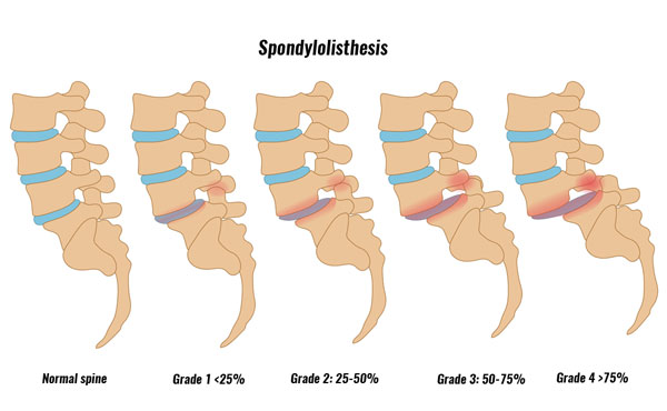 [신탄진 한의원] 퇴행성 전방전위증(Spondylolisthesis) : 네이버 블로그