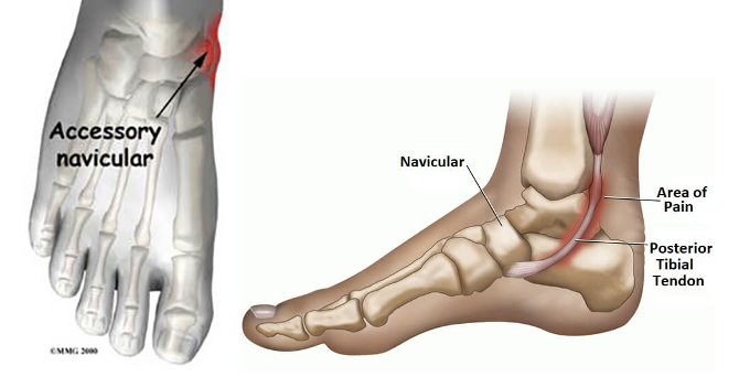 Accessory Navicular Syndrome (부주상골증후군) : 네이버 블로그