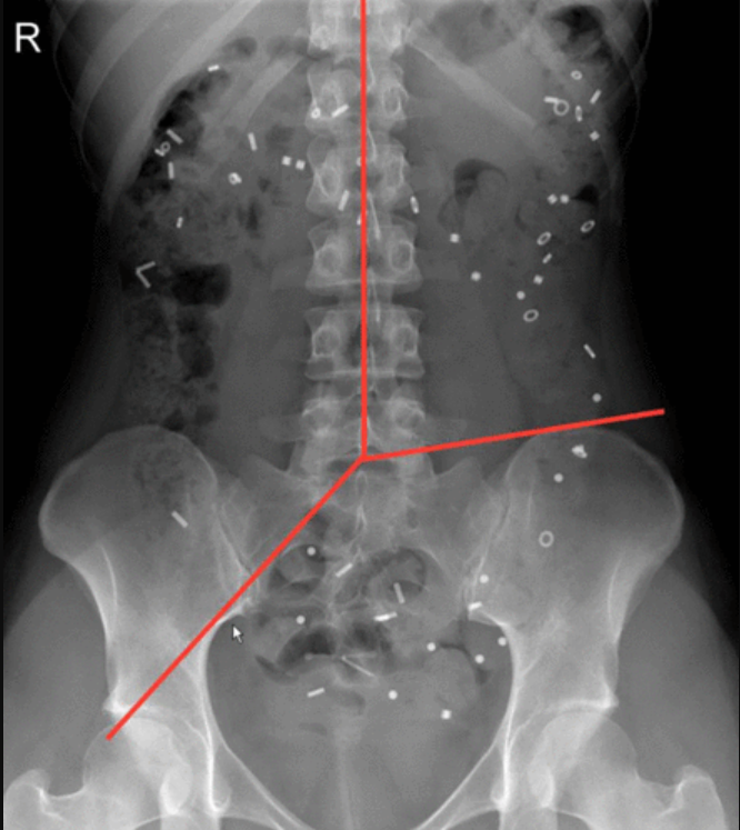 [투시조영] 대장정복술(Reduction) / 대장통과검사(CTTS) : 네이버 블로그