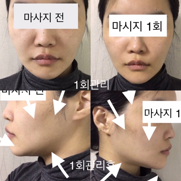 성형시술수술후가만있을땐갠찮은데웃을때근육이밀리고나씹히는현상들러붙는거느낌의현상웃을때광대올라가는게불편앞옆광대가더튀어나온다