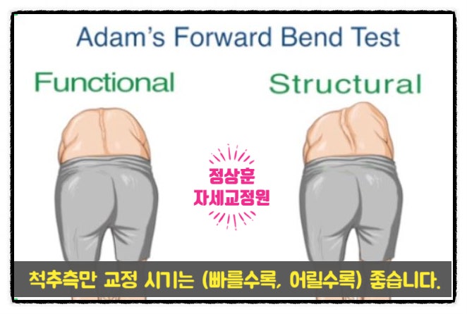 사례32 척추측만증 교정시기는 빠를수록어릴수록좋습니다 네이버 블로그