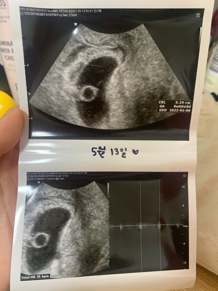 임신일기;7w4d_고사난자,유산,산부인과오진,7주심장소리 : 네이버 블로그