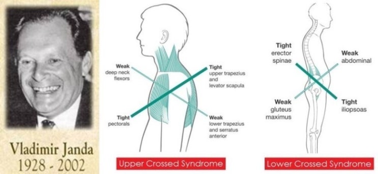 Janda Syndrome 얀다 신드롬 : 네이버 블로그