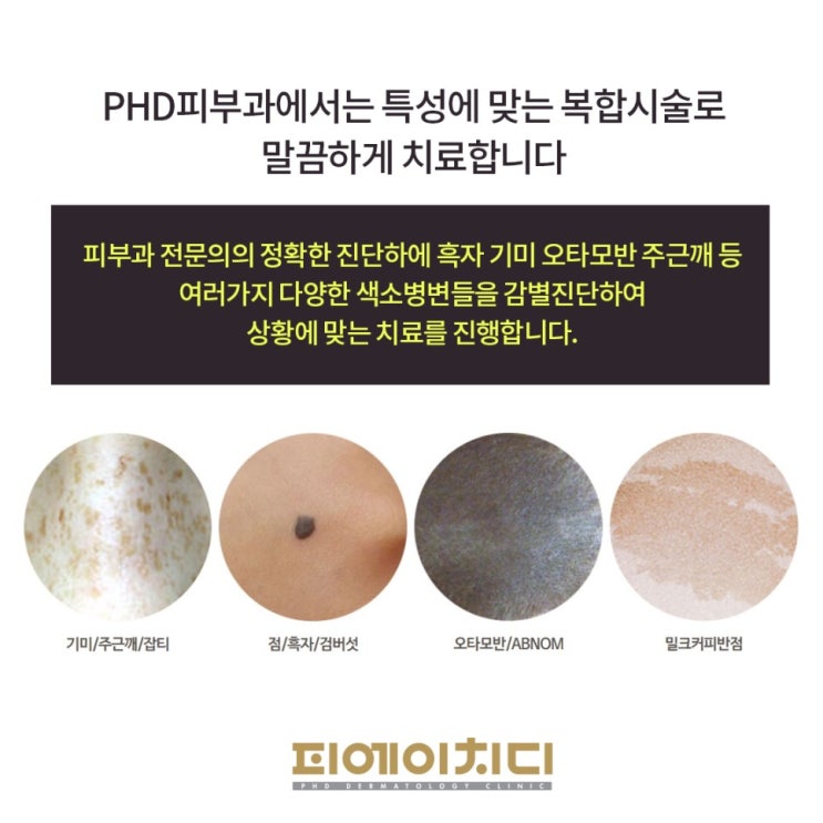 듀얼 레이저토닝 점제거 기미 주근깨 흑자 제거 색소치료 미백 화이트닝 피코 포토나 효과 가격 성신여대 피부과 Phd피부과