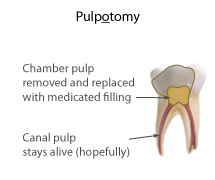 어린이 신경치료: 신의료기술로 지정된 부분신경치료 이야기(MTA pulpotomy) : 네이버 블로그