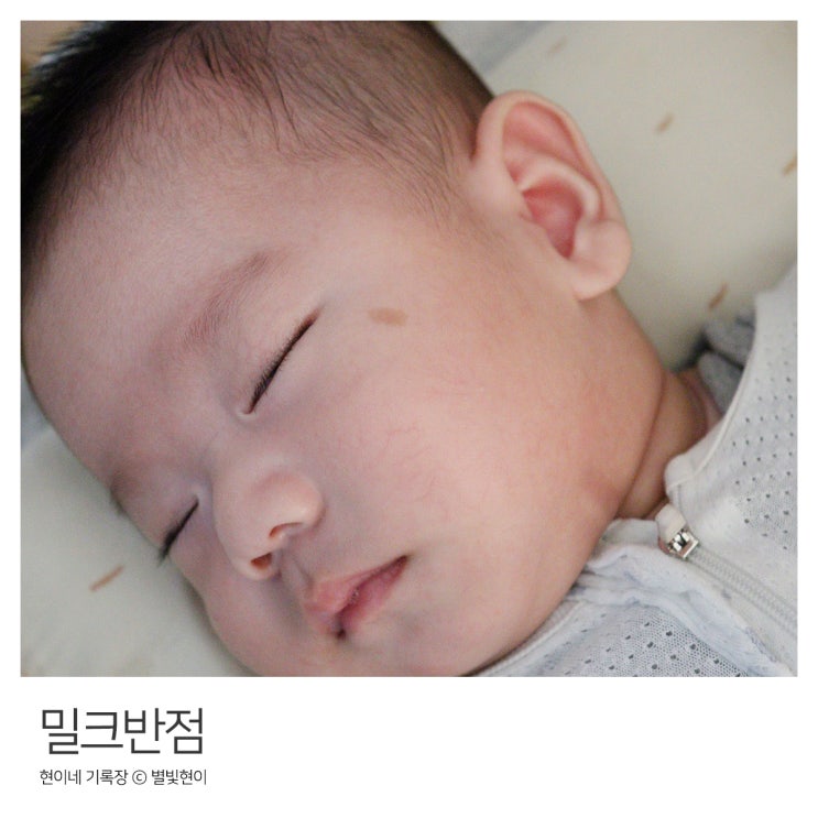 아기밀크반점 이소성몽고반점 특징 혹시 신경섬유종 상담받은 썰 네이버 블로그