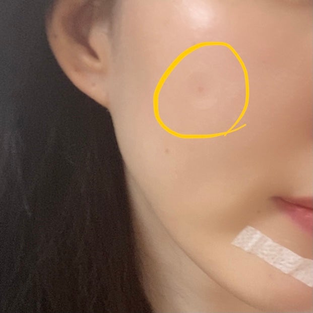 아크로패스 여드름 니들 패치 사용 후기 트러블 큐어and스팟이레이저 올리브영 니들패치 네이버 블로그