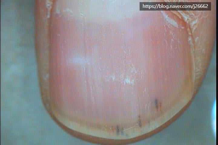 손발톱선상출혈(가시출혈, Splinter hemorrhage) : 네이버 블로그