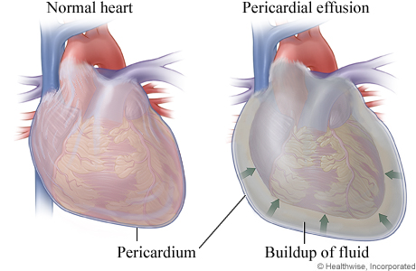 Pleural/Pericardial fluid drainage (흉수, 심낭삼출 drain) : 네이버 블로그