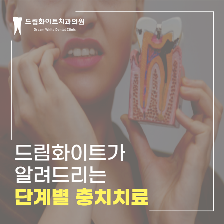 양산 추천 치과 드림화이트치과에서 충치 초기에 치료하세요 네이버 블로그