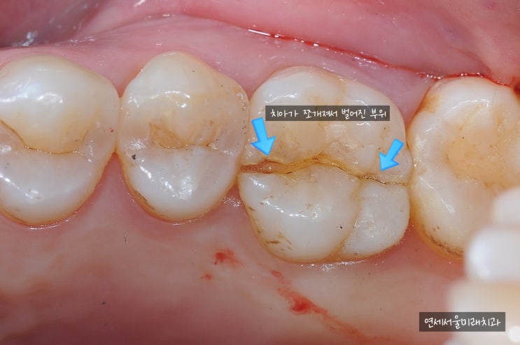[봉담치과] 치아가 깨졌어요, 씹을 때 아파요, split tooth에 대하여 : 네이버 블로그