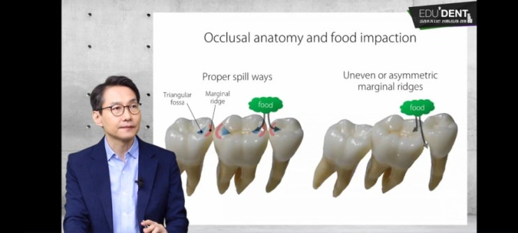 [에듀덴트] food impaction , 알수없는 궁금증을 파헤치다 - 박휘웅 원장님 2/2 : 네이버 블로그