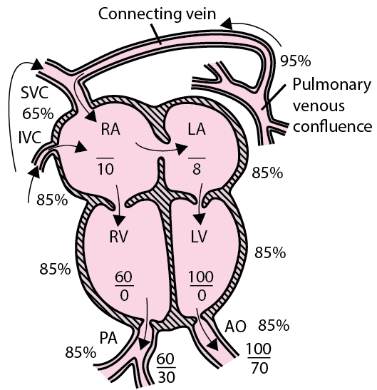 total anomalous pulmonary venous return(TAPVR, 총폐정맥환류이상증) : 네이버 블로그