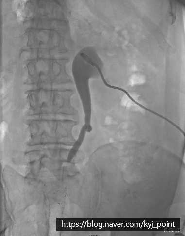 PCN(Percutaneous Nephrostomy;경피적 신루술), D-J Stent insertion(Double J ...