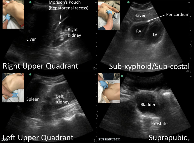 복부 초음파검사(Abdominal Ultrasound) : 네이버 블로그