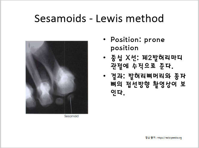 [일반촬영] 종자뼈 Lewis법 (Sesamoids - Lewis method) : 네이버 블로그