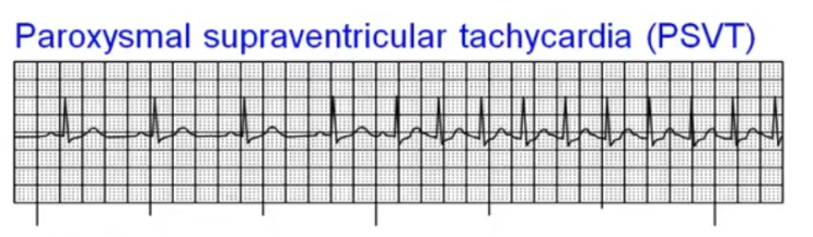 PSVT(Paroxysmal supraventricular tachycardia, 발작성 심실상성 빈맥) : 네이버 블로그