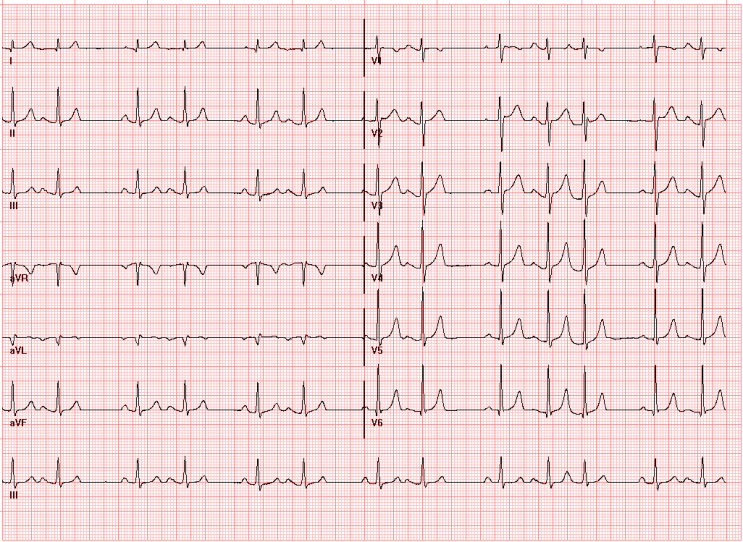 Wenckebach AV block with Wenckebach SA block : 네이버 블로그