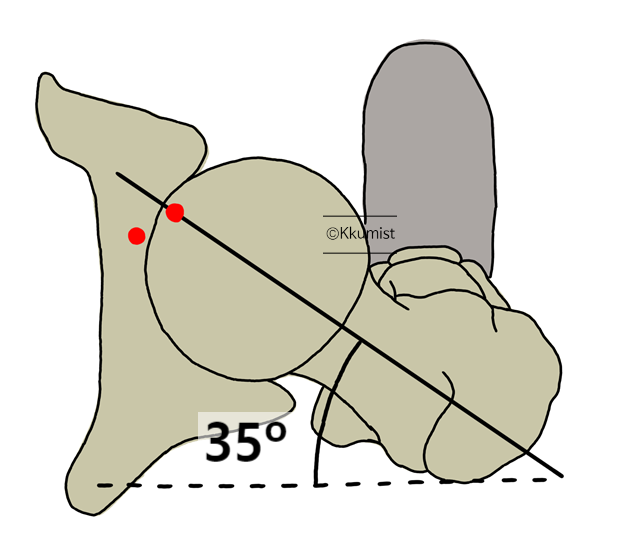 내반슬(Genu varum) O다리, 경사각(angle of inclination)과 넙다리뼈 비틀림(femoral ...