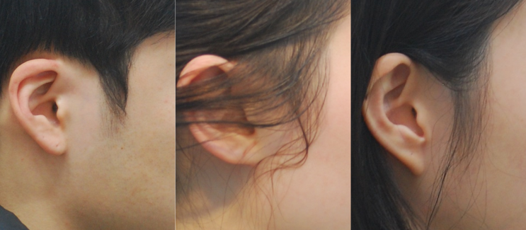 광대 수술 후 피부 절개선에는 왜 흉터가 안 생길까? (feat. RSTL) : 네이버 블로그