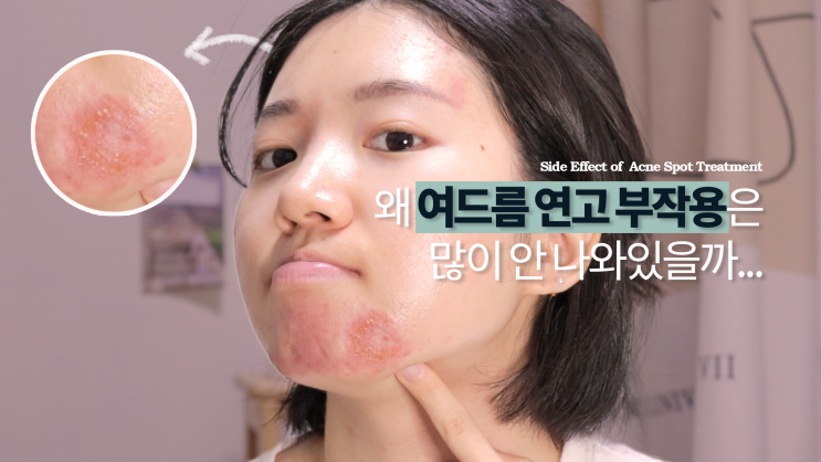 벤조일퍼옥사이드 부작용으로 접촉성피부염 얻은 썰 뉴트로지나 래피드 클리어 후기 파티마겔 여드름 스팟 연고 부작용