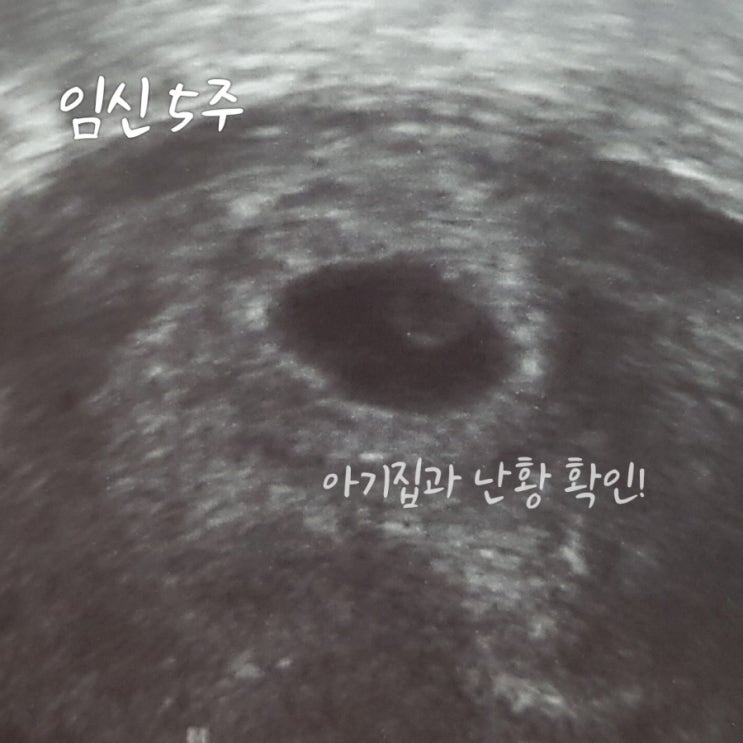 둘째맘이 겪은 임신극초기 증상 임신 2주 4주 5주 6주 자궁 내 피고임으로 응급실 갈색혈 증상 네이버 블로그