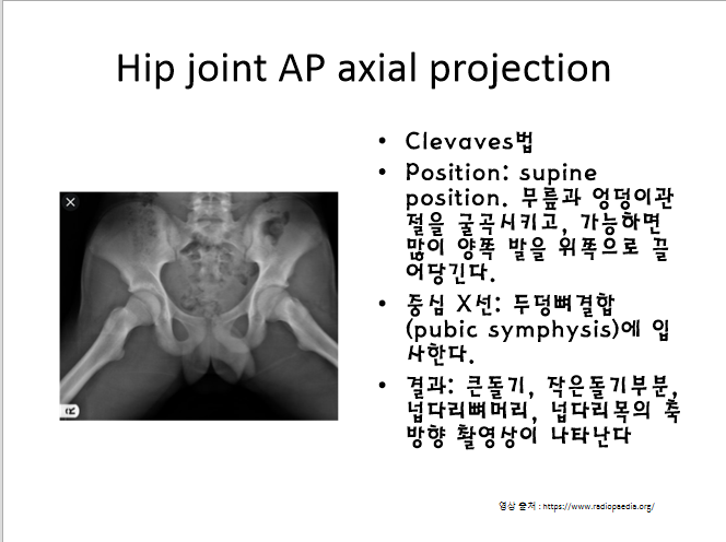 [일반촬영] 엉덩이관절 앞뒤 축방향 촬영(Hip joint AP axial projection) : 네이버 블로그