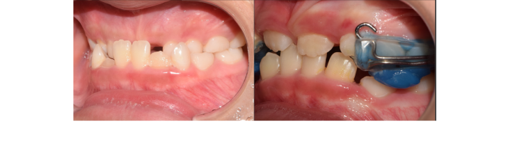 [365치과 케이스룸] 아이 아래턱이 많이 자라서 반대로 물려요(Feat. bonded RPE + FM) : 네이버 블로그