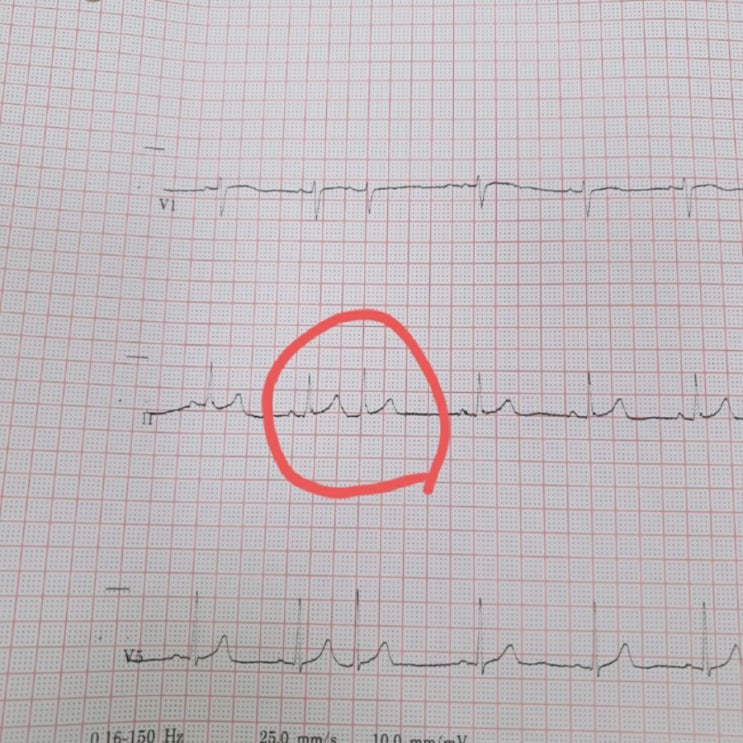 Supraventricular Premature Complexes : 네이버 블로그