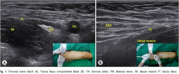 Femoral nerve block 대퇴신경 차단술 : 네이버 블로그