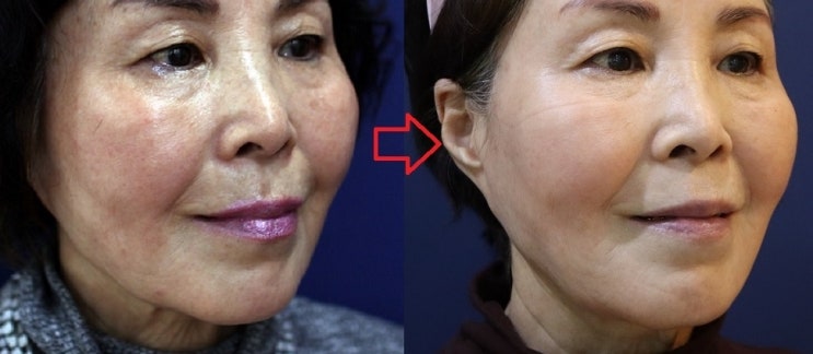 브이빔 레이저 효과 부작용 전후 사진 경과 안면홍조 주사 피부염 주사비 딸기코 모세 혈관 확장 여드름 치료