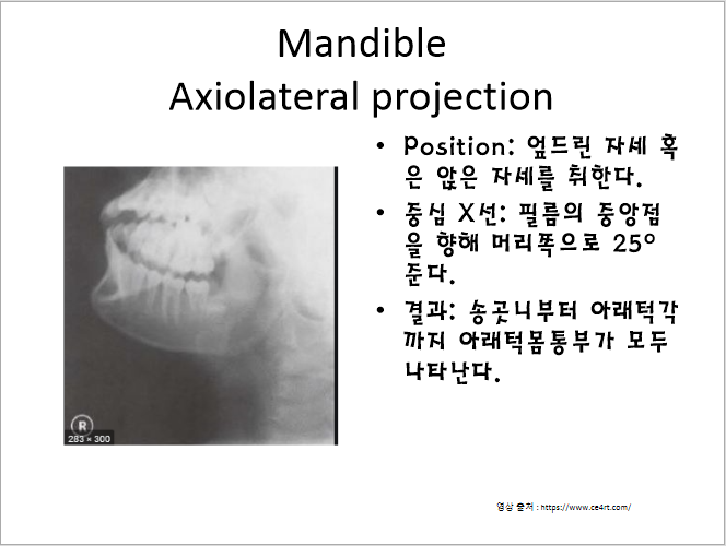 [일반촬영] 아래턱뼈 축옆방향 촬영 (Mandible Axiolateral projection) : 네이버 블로그
